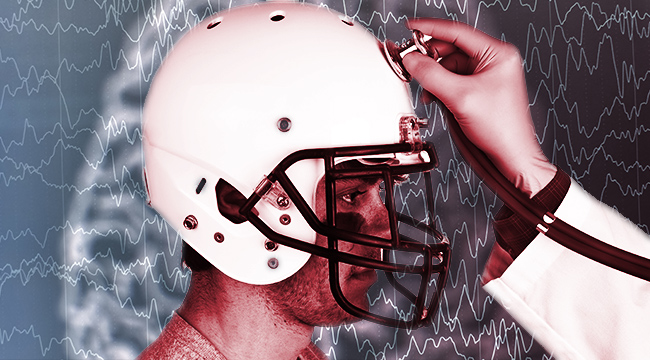 Why The NFL CTE Study Is Important Well Beyond Football