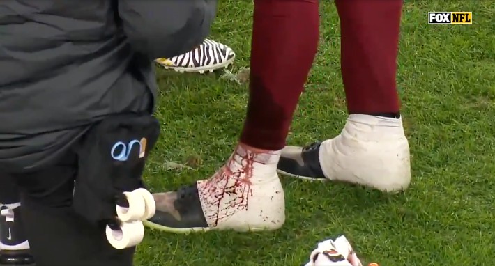 Bloody Alex Smith Helped Washington Kick A Bizarre Halftime Field Goal